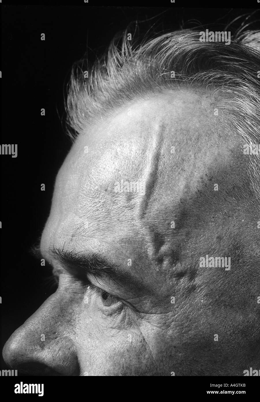 Temporal arteritis, also known as giant cell arteritis Stock Photo - Alamy