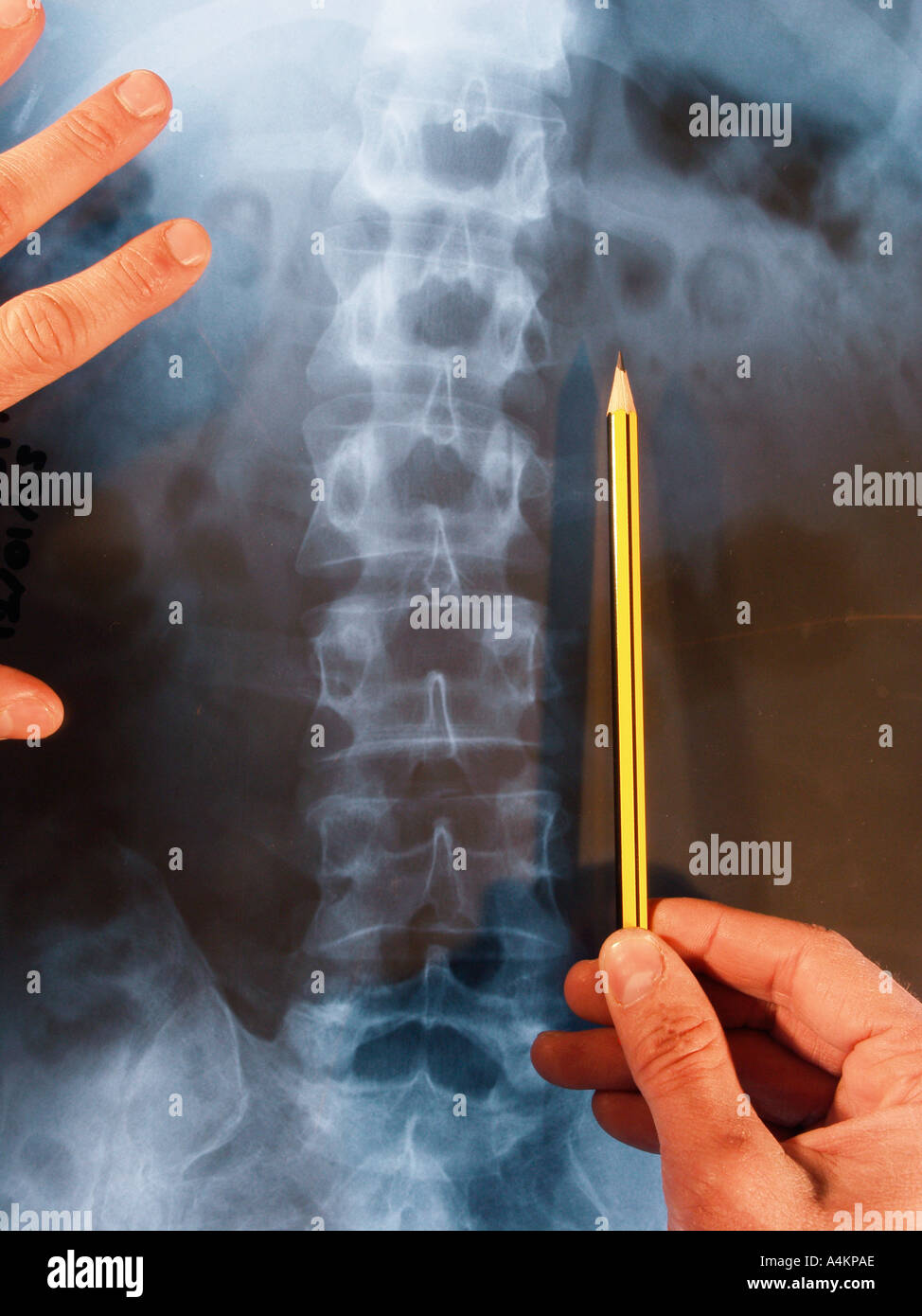 Bone malformation hi-res stock photography and images - Alamy