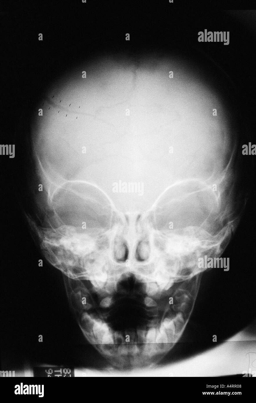 Skull upper part hi-res stock photography and images - Alamy