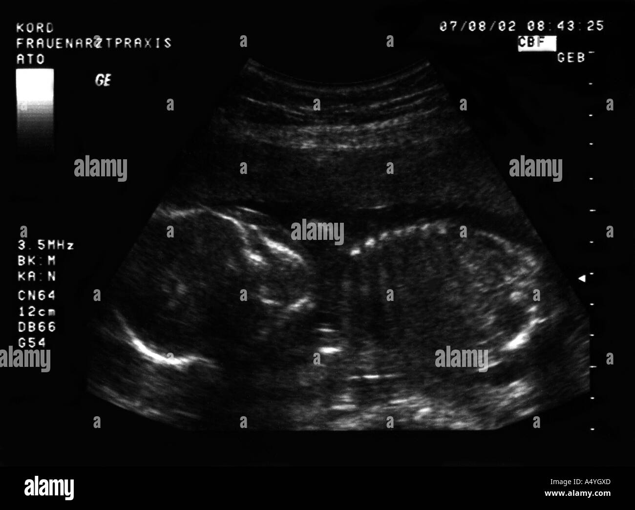 Ultrasound image of a fetus Stock Photo - Alamy