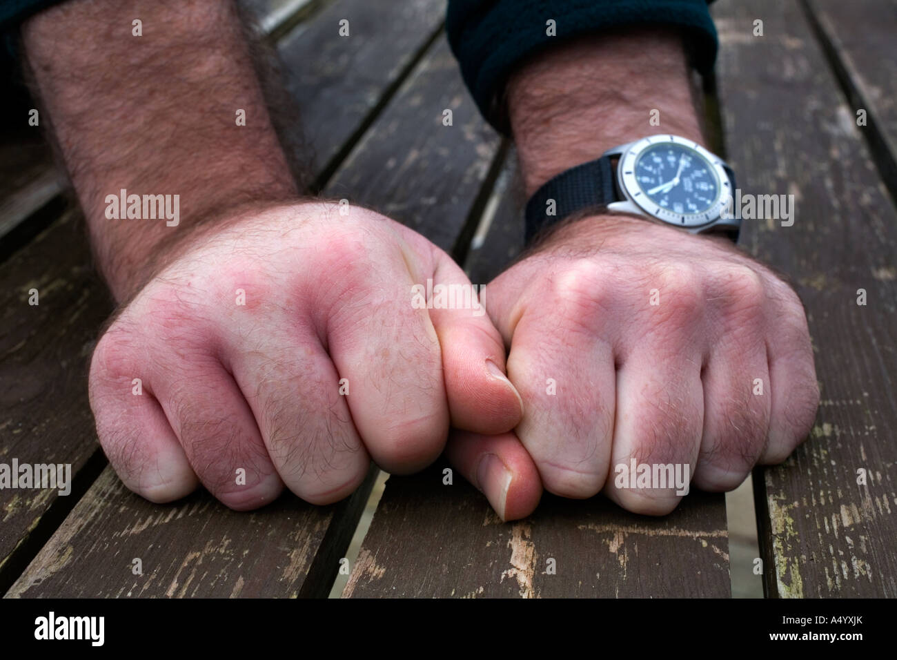 comparison of hands after a wasp has stung the one on the left shows ...
