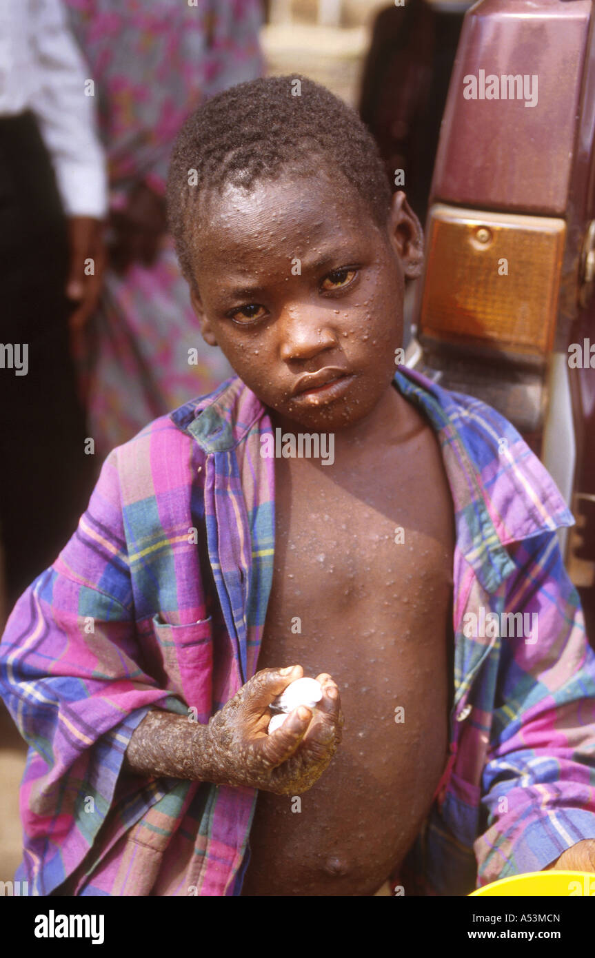 Painet ha1623 3266 uganda boy full blown aids masaka country developing ...