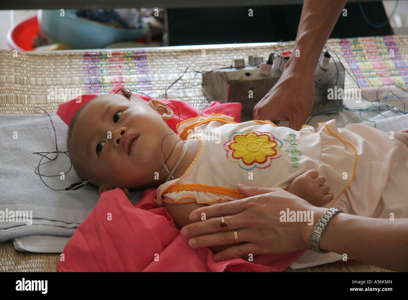 Painet iy8729 vietnam child kid receiving acupuncture treatment ...