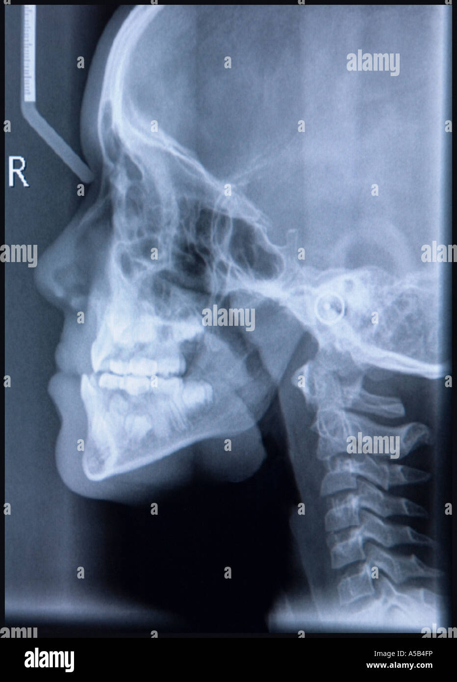 Profile xray of a skull Stock Photo - Alamy