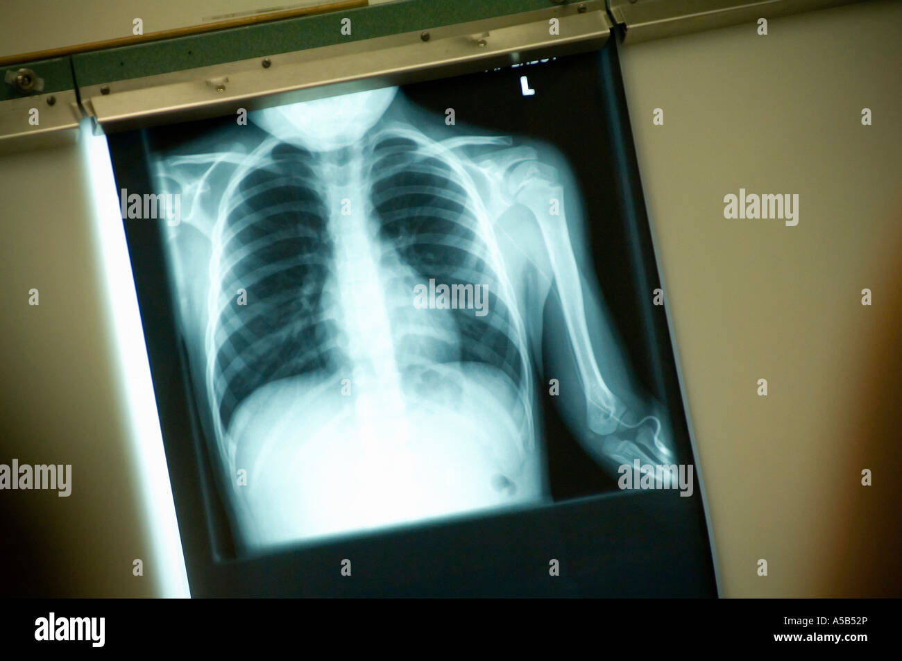 X-ray of torso Stock Photo - Alamy