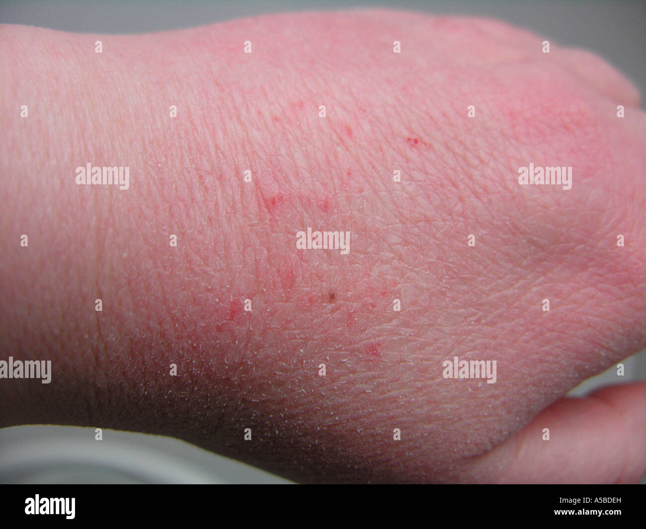 dermatitis of the hand Stock Photo - Alamy