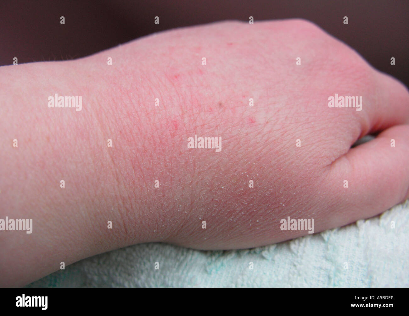 dermatitis of the hand Stock Photo - Alamy