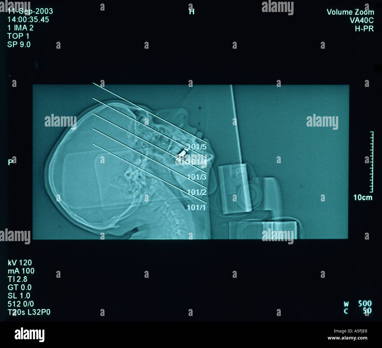 CAT Scan of a human skull Stock Photo - Alamy