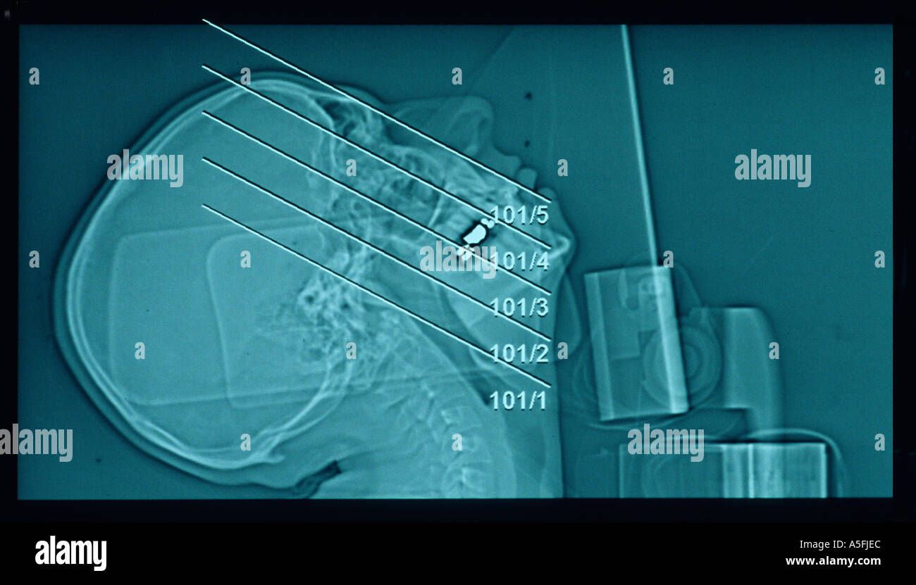 Cat scan human skull hi-res stock photography and images - Alamy