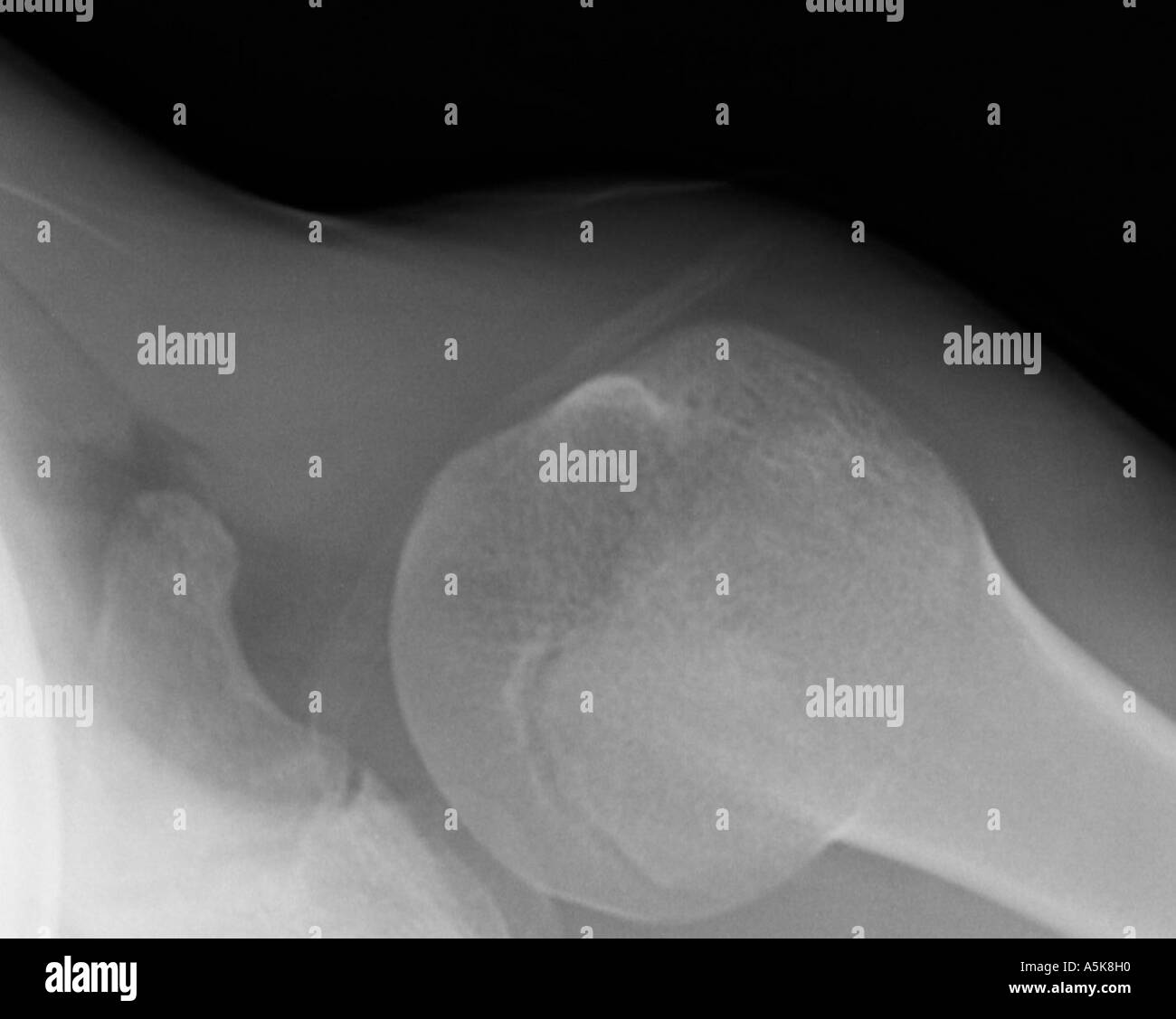 X Ray of a young boy s right shoulder Stock Photo - Alamy