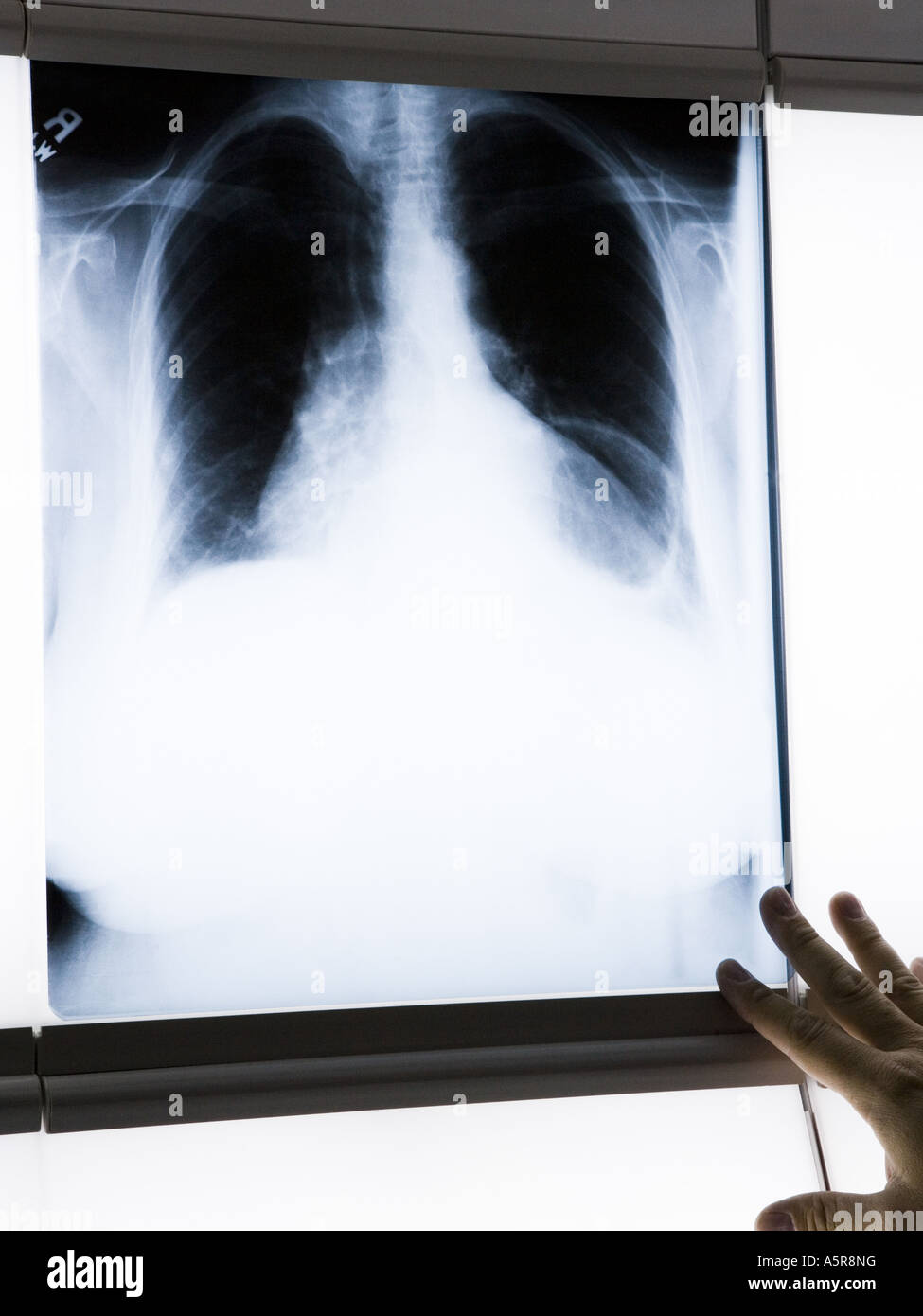 Chest x ray with male hand Stock Photo - Alamy