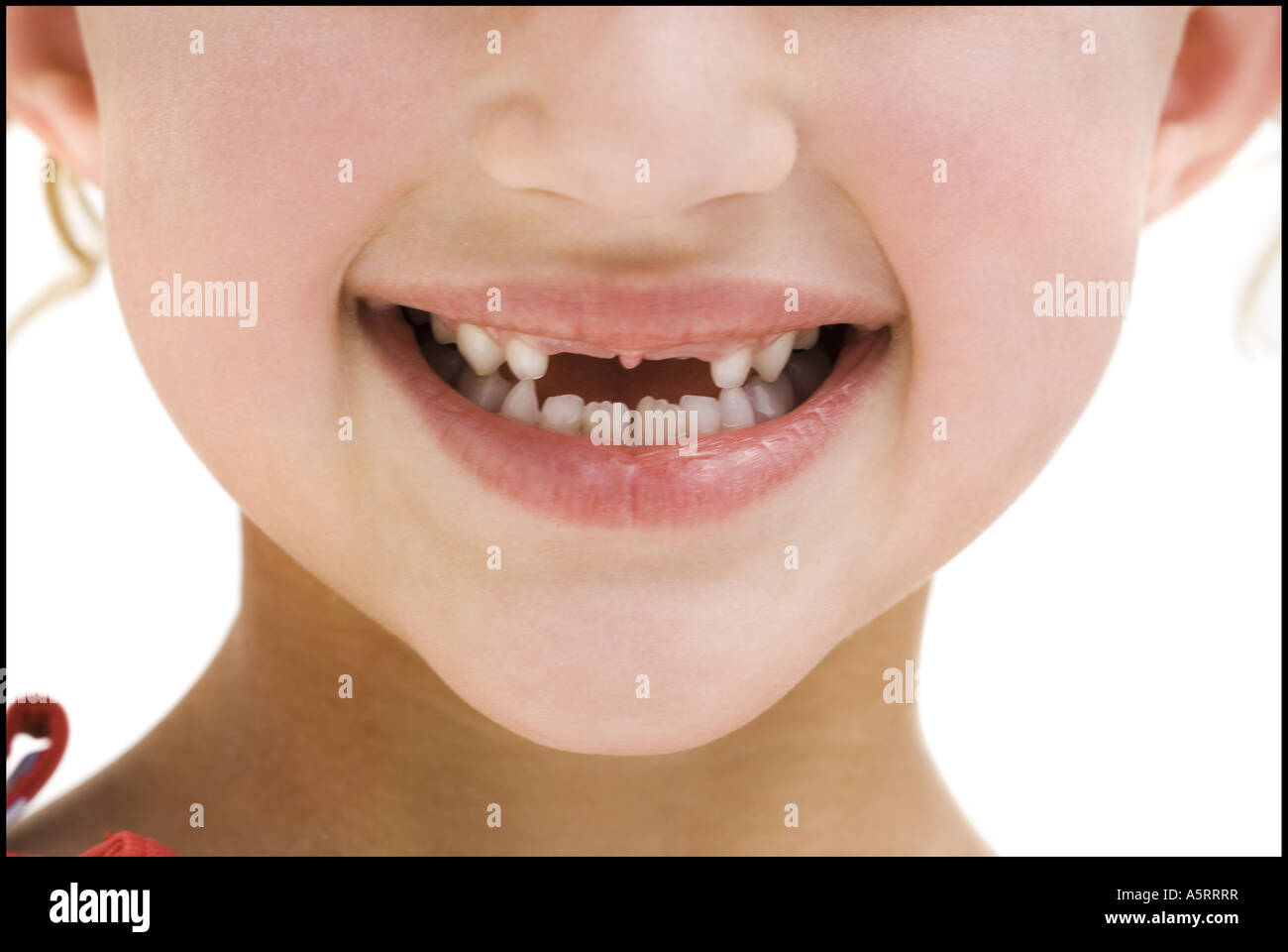 Close up of young girl s smile with missing front teeth Stock Photo - Alamy