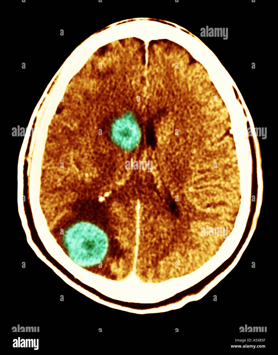 Brain metastases mri hi-res stock photography and images - Alamy