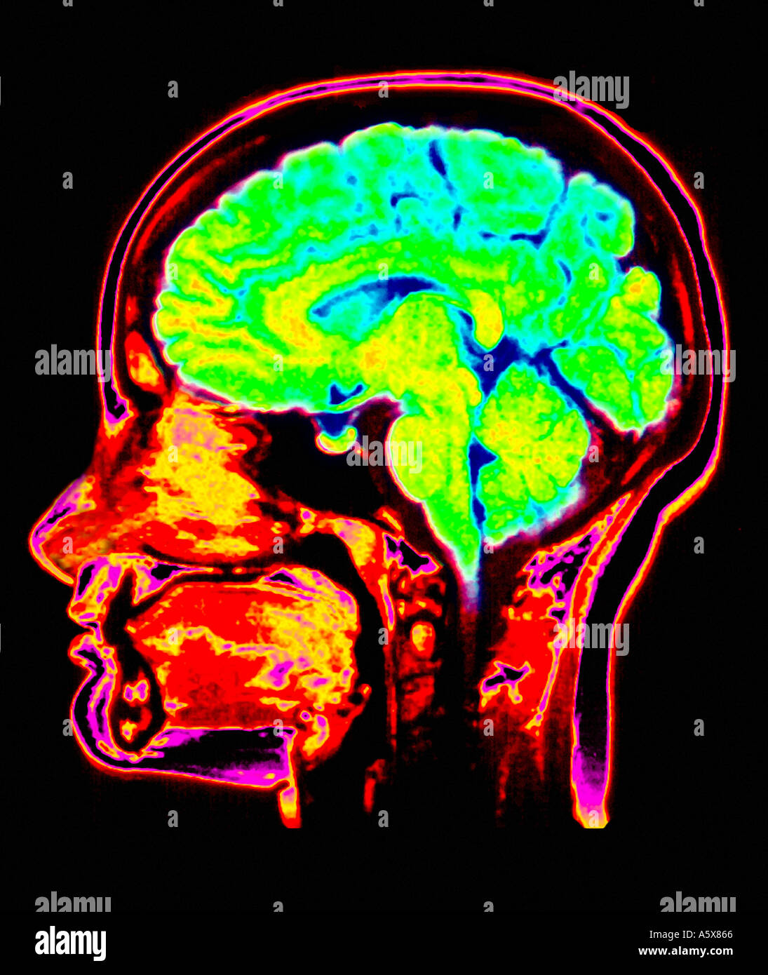 Mri cerebellum highlighted hi-res stock photography and images - Alamy