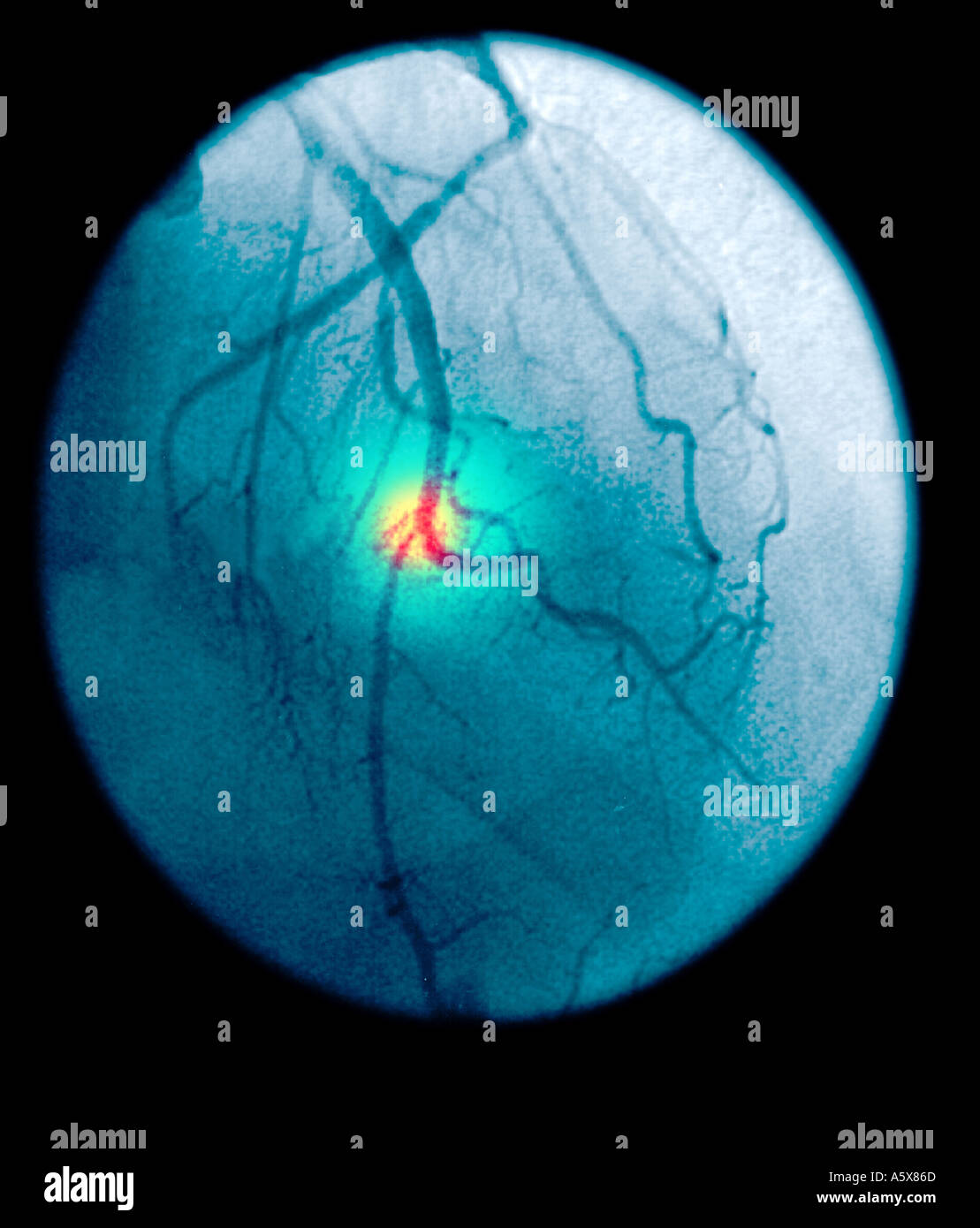 colorized xray of the left anterior descending coronary artery lesion ...