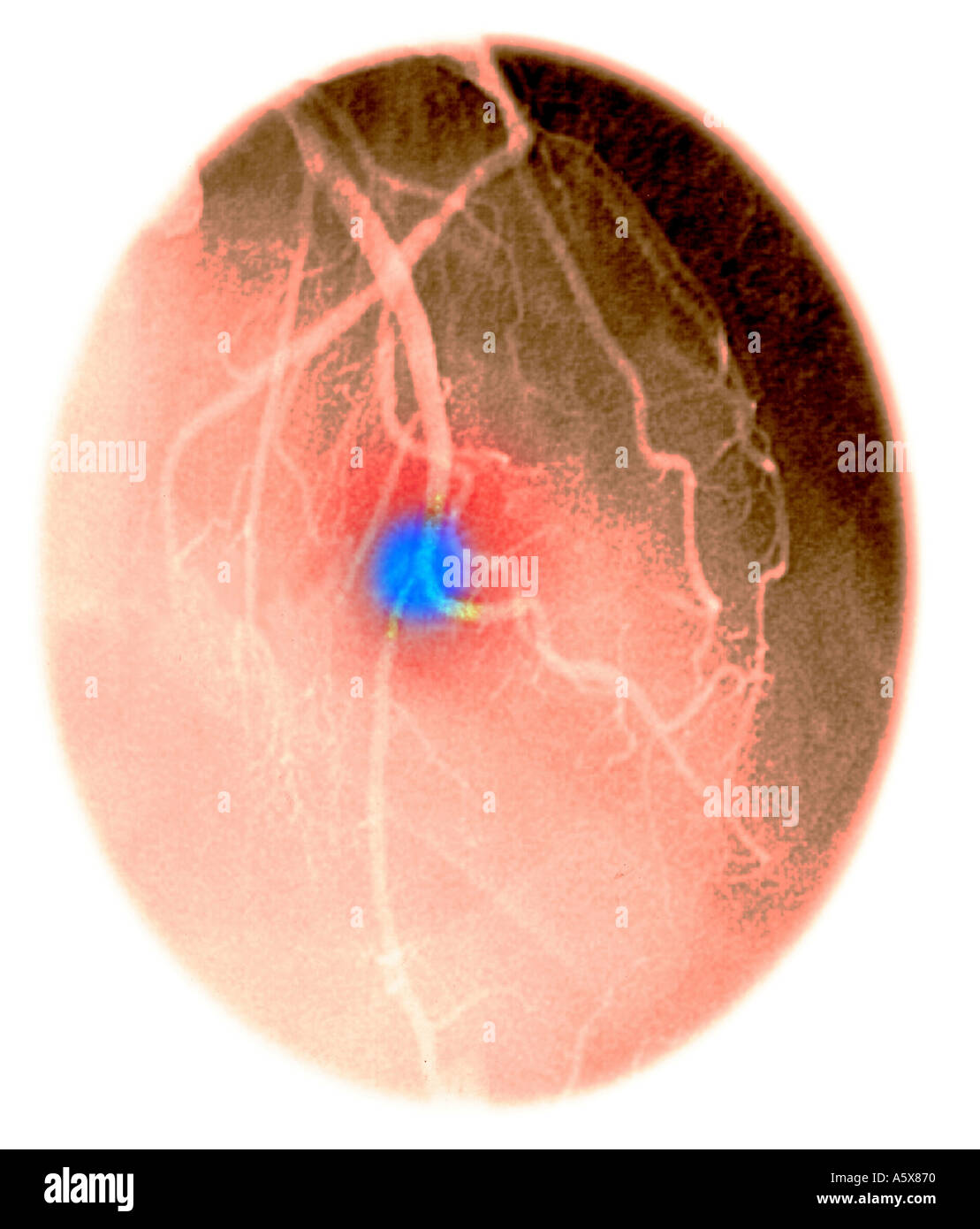 colorized xray of the left anterior descending coronary artery lesion ...