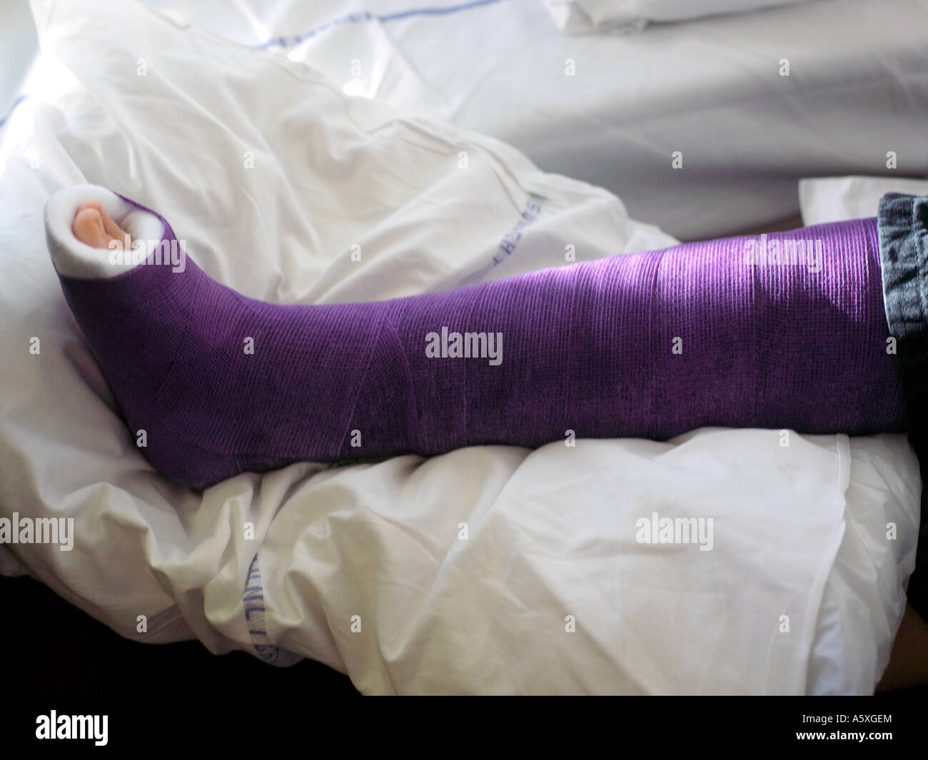 Eight Year Old Girl with Purple Plaster Cast on Leg in Hospital Stock ...