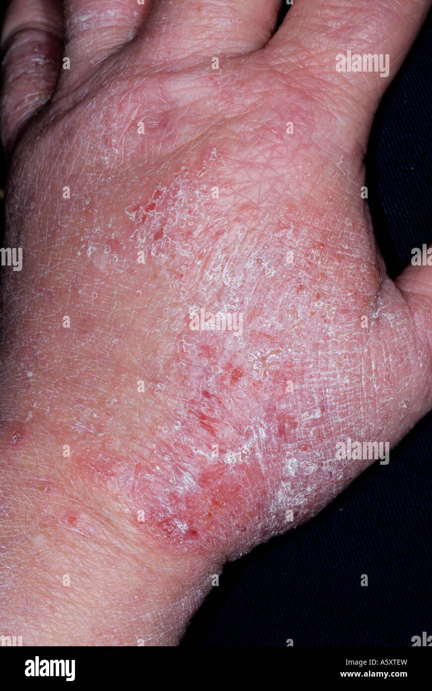 Skin rash of eczema on the hands of a 52 year old female Stock Photo ...