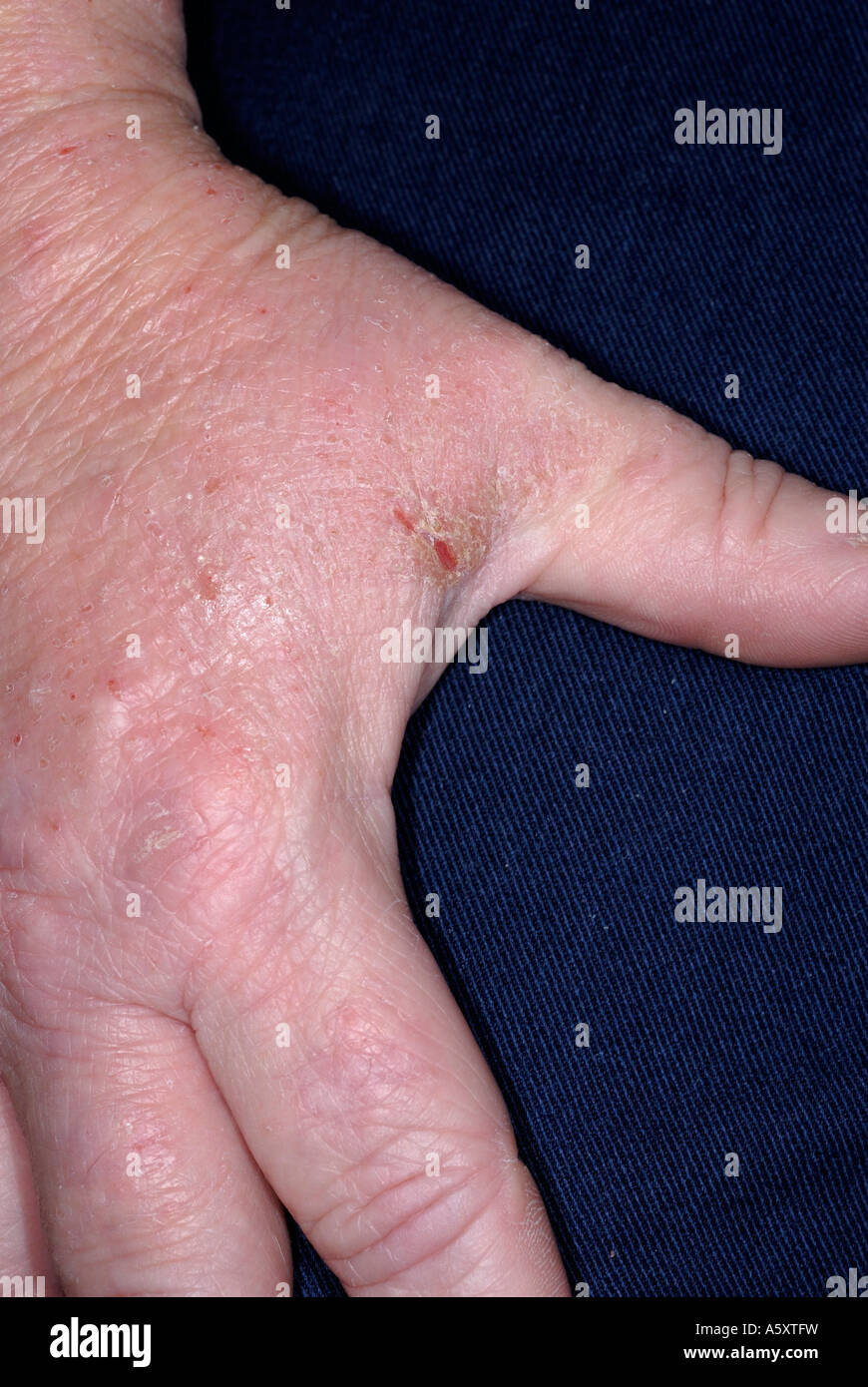 Scaling rash hi-res stock photography and images - Alamy