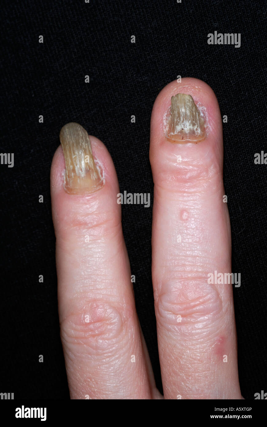 Hands of a 36 year old woman with epidermolysis bullosa Stock Photo - Alamy