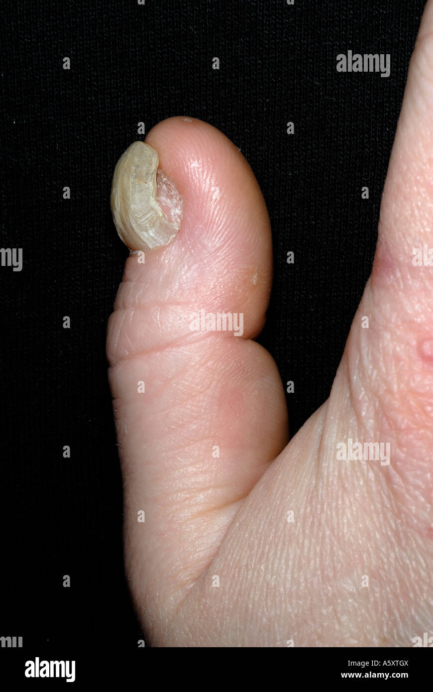 Epidermolysis bullosa hi-res stock photography and images - Alamy