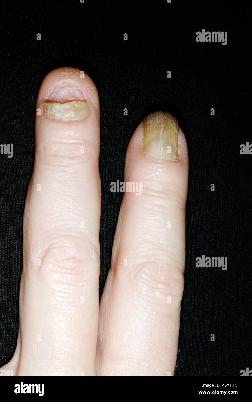 Epidermolysis bullosa hi-res stock photography and images - Alamy