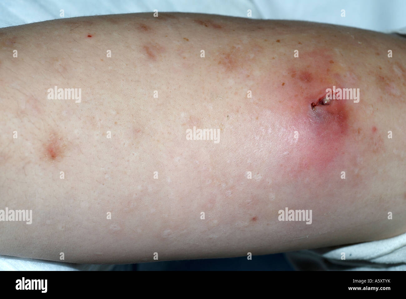 Staphylococcus Aureus Infection
