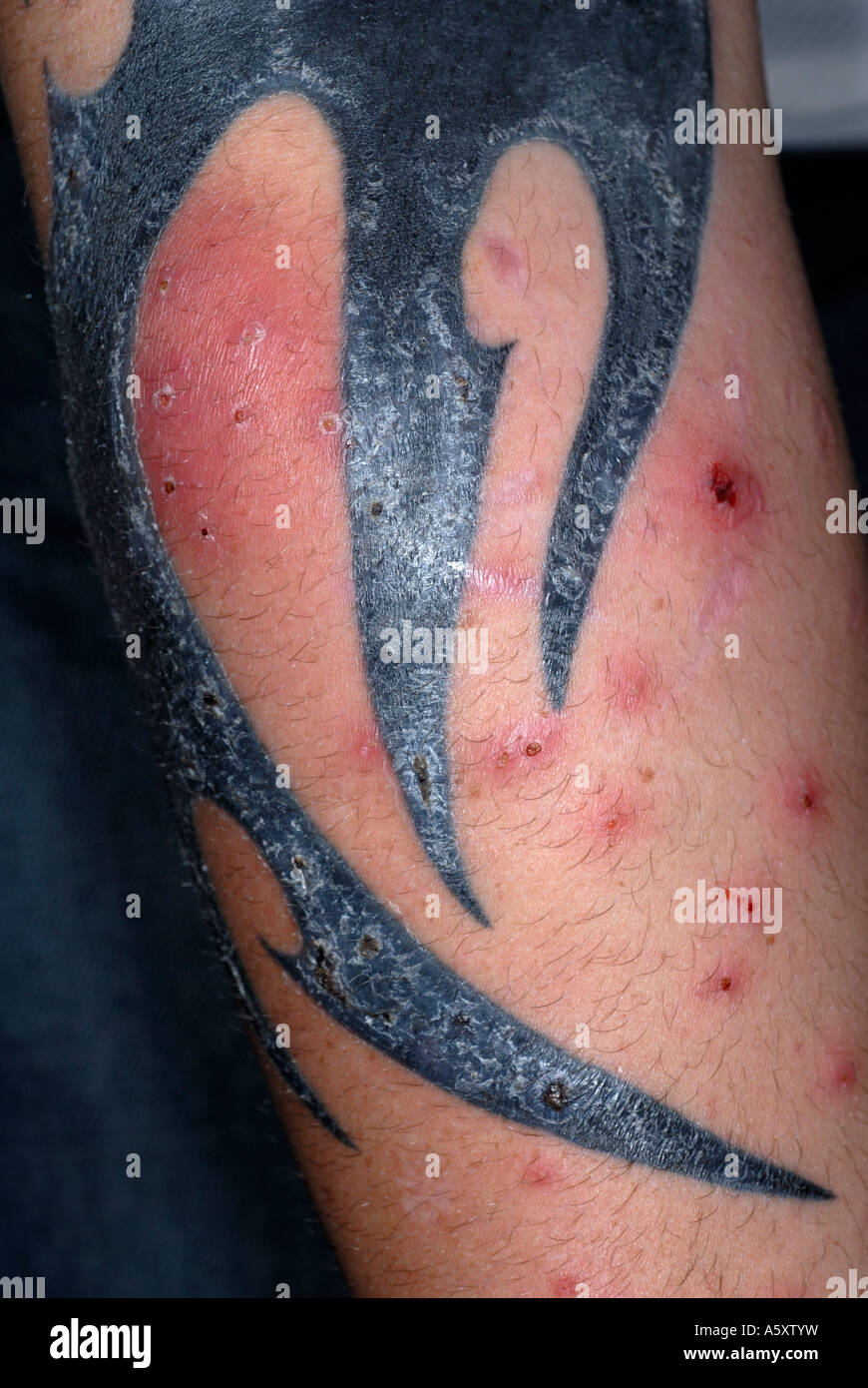 Staph Infection Skin Tattoos Staph Infection Stages: Pictures And