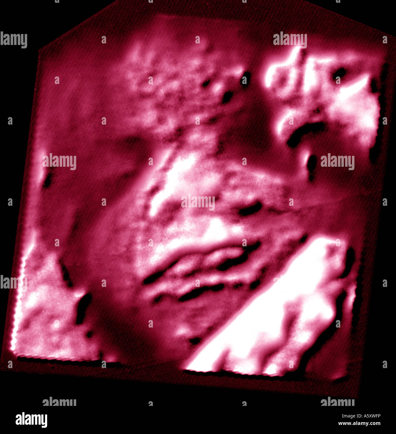 3D fetal ultrasound of the face of a human fetus in mother s uterus ...