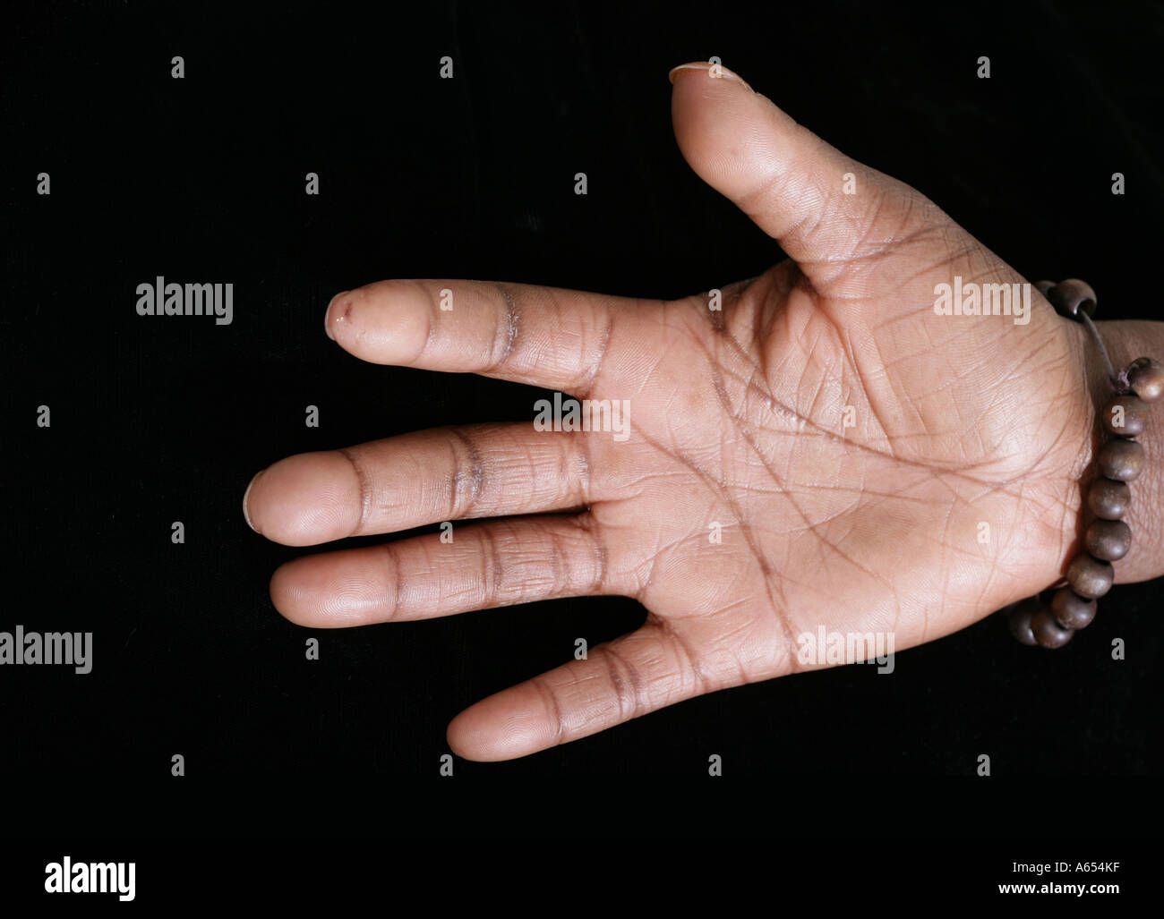 Hand with Raynaud's syndrome Stock Photo - Alamy