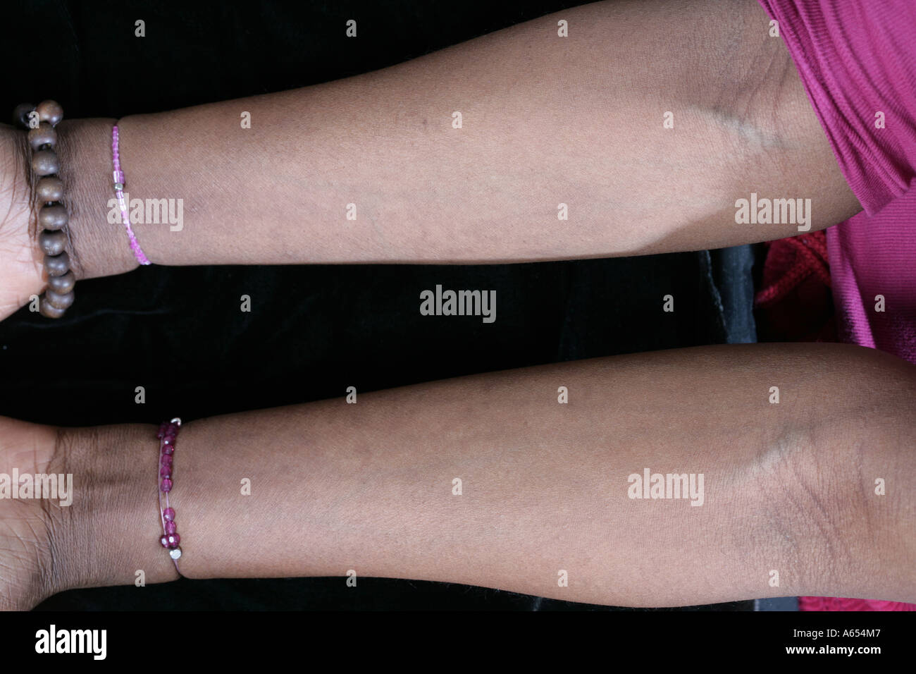 African American woman shows her arms with a chronic skin discoloration ...