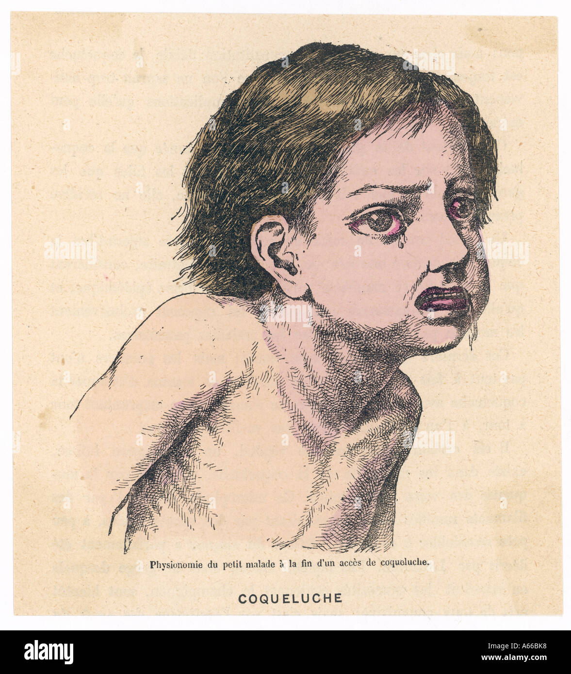 Whooping cough children hi-res stock photography and images - Alamy