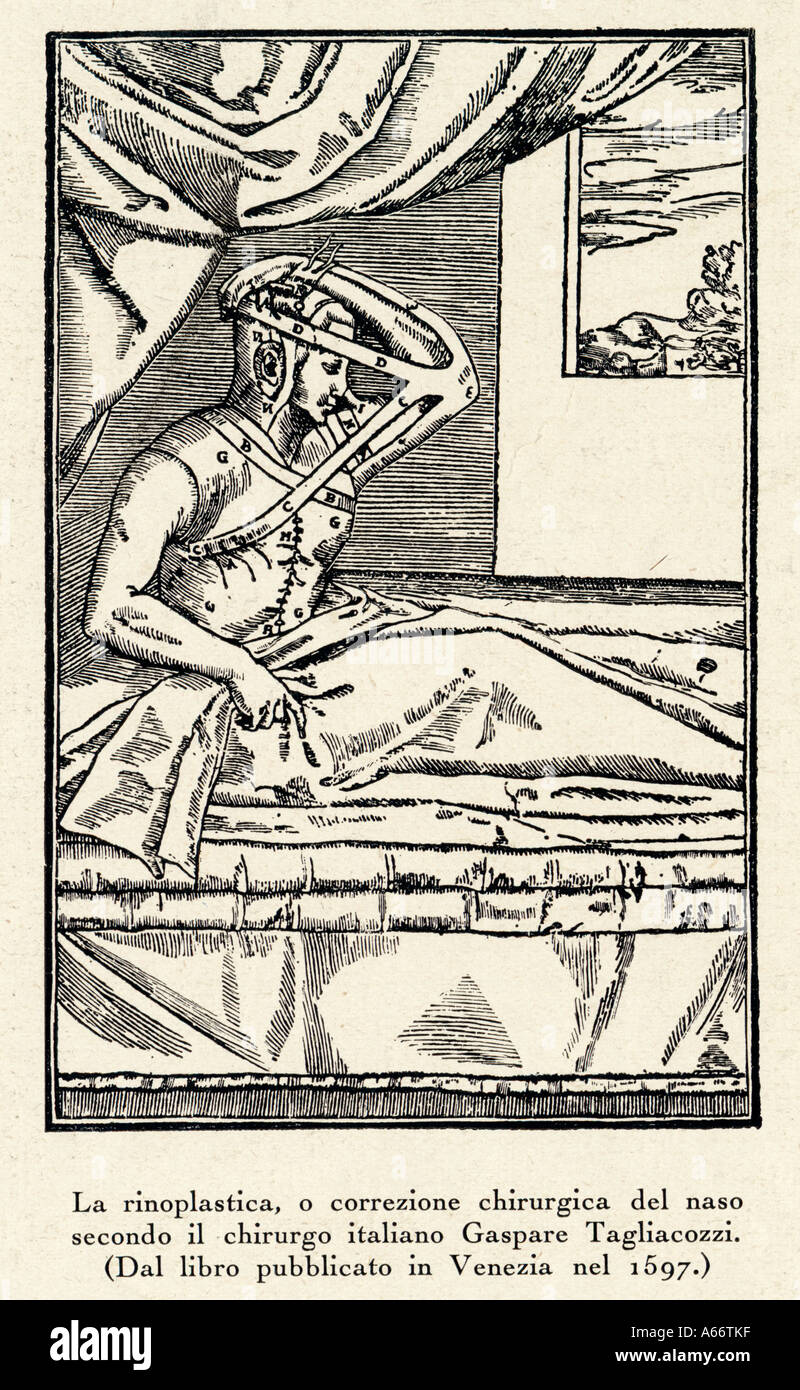 Rhinoplasty c16th hi-res stock photography and images - Alamy