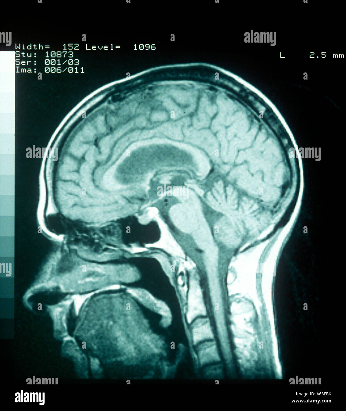MRI scan of the lateral skull Stock Photo - Alamy