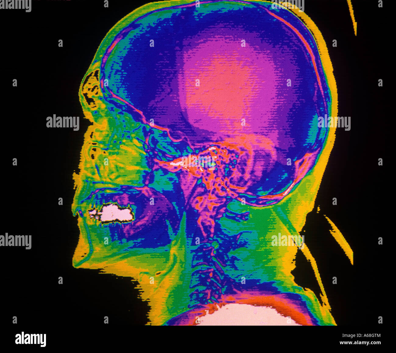 Color CT scan of the lateral skull Stock Photo - Alamy Color CT scan of the lateral skull Stock Photo - Alamy