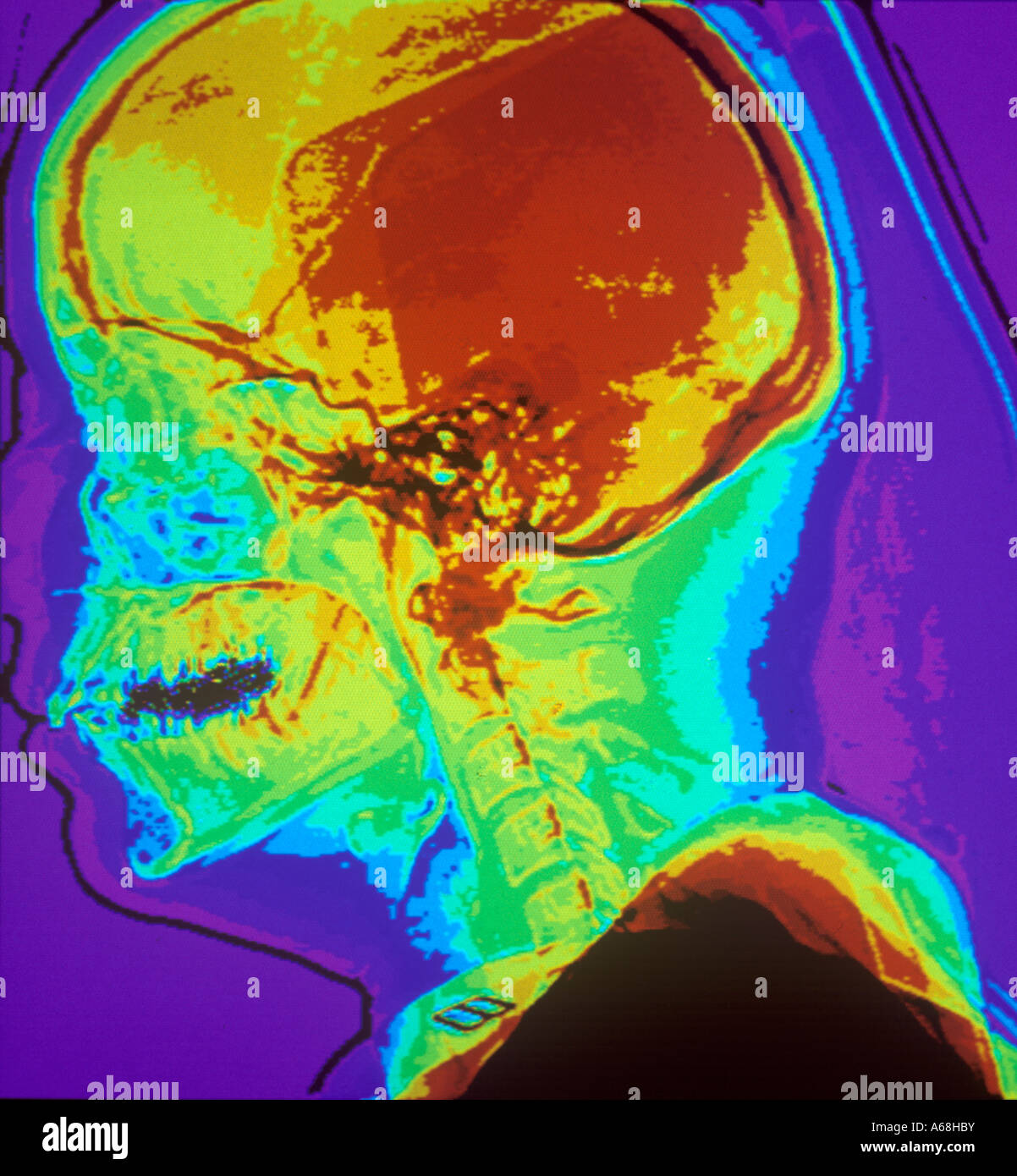 Color CAT scan of the lateral skull Stock Photo - Alamy