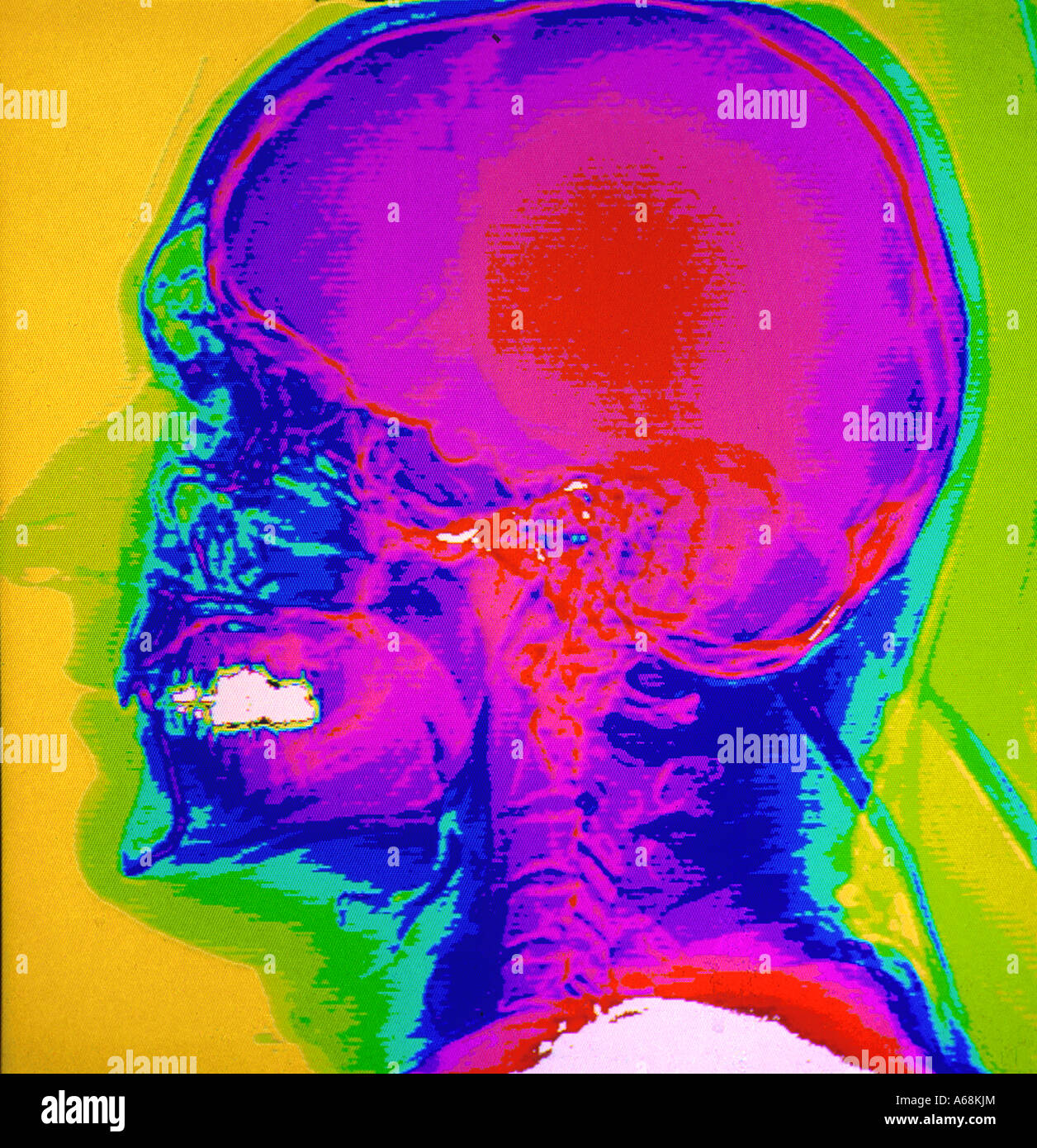 Color CAT scan of the lateral skull Stock Photo - Alamy