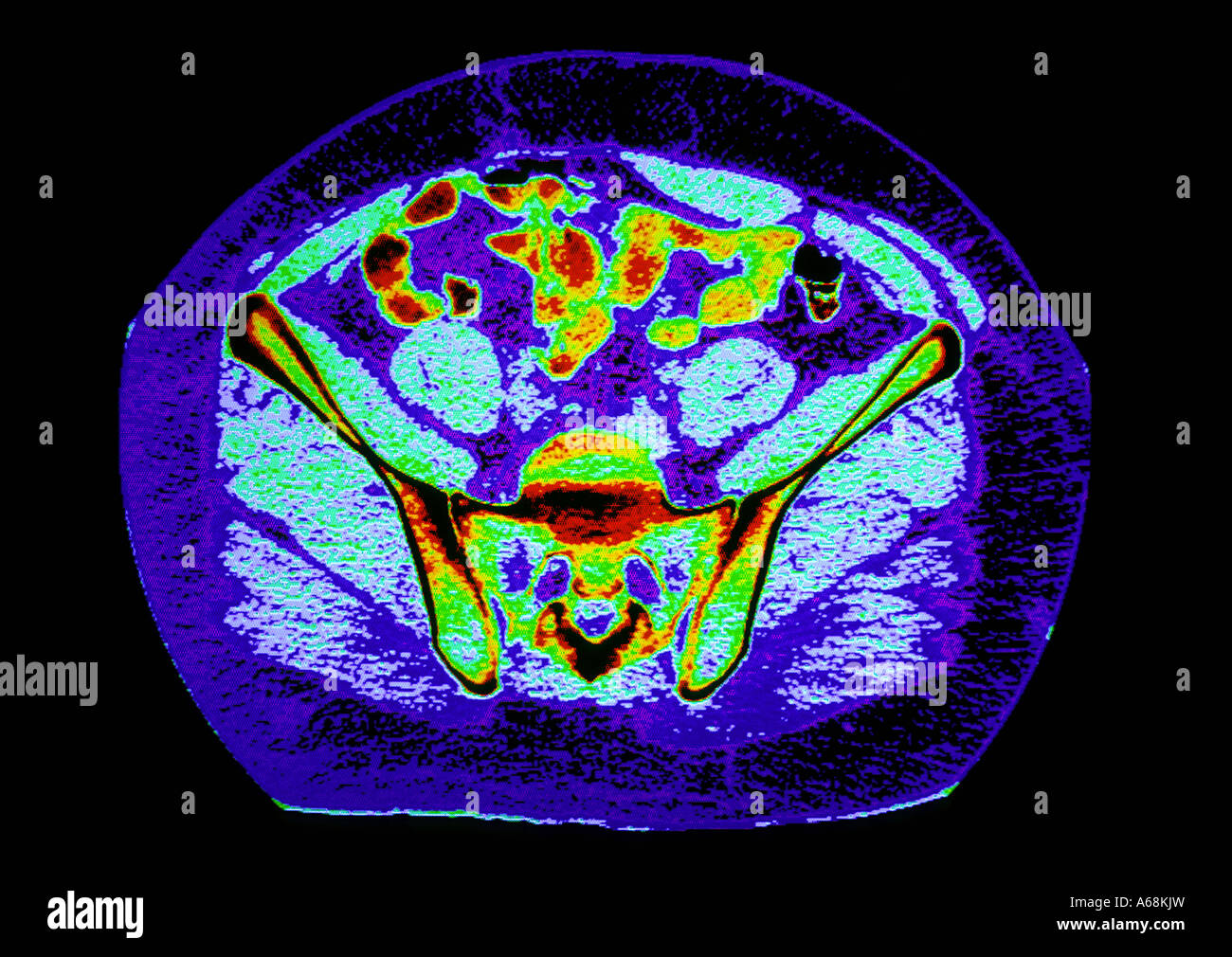 Color CAT scan of the pelvis Stock Photo - Alamy