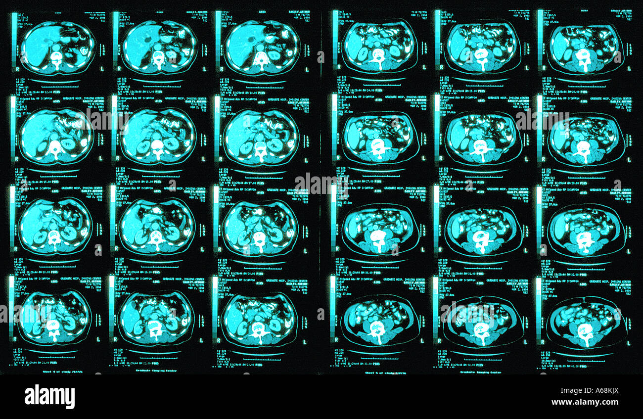 Mri scans hi-res stock photography and images - Alamy
