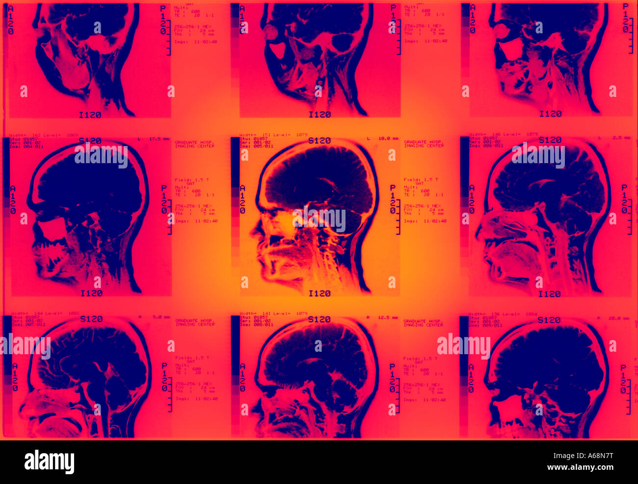 MRI lateral skull Stock Photo - Alamy
