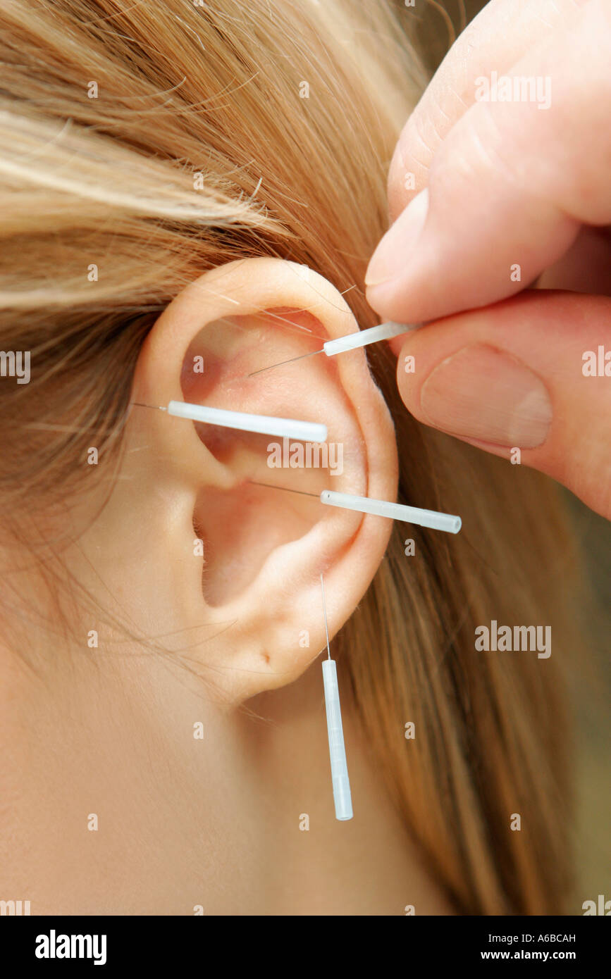 Women receiving acupuncture treatment Stock Photo - Alamy