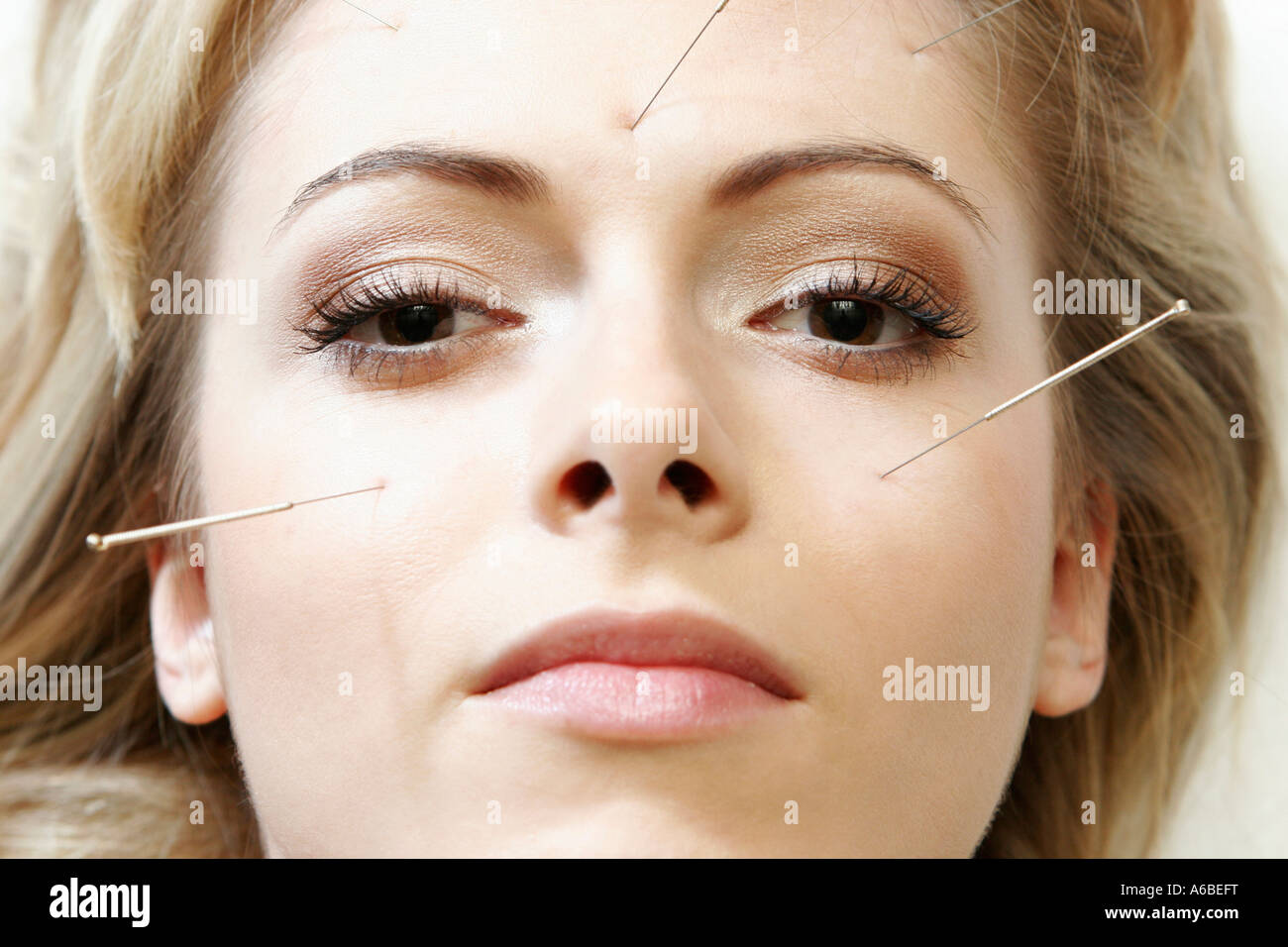 Women receiving acupuncture treatment Stock Photo - Alamy