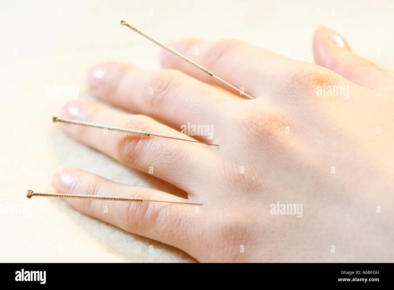 Accupuncture treatment hi-res stock photography and images - Alamy