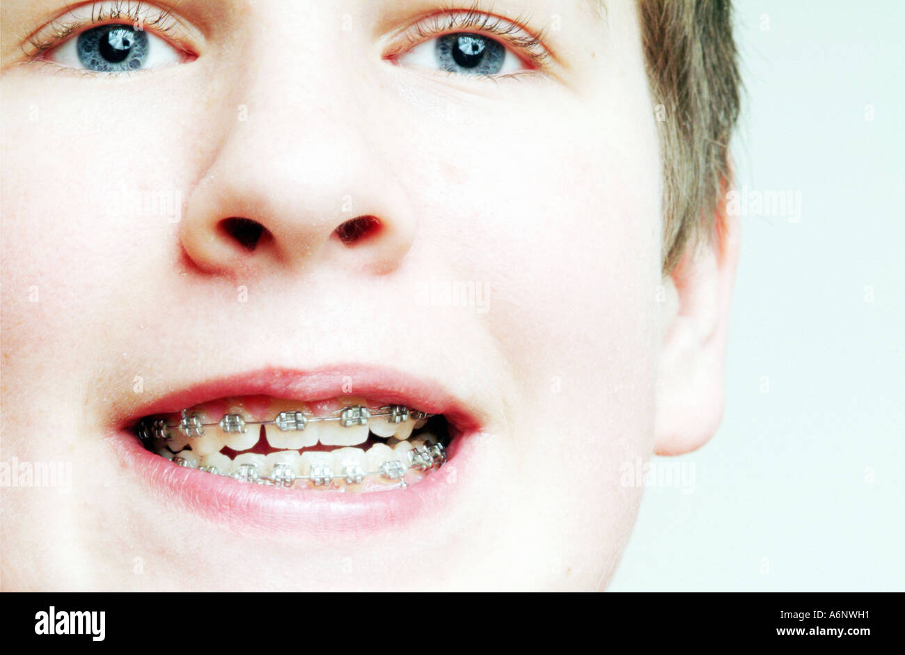 Fixed dental brace hi-res stock photography and images - Alamy