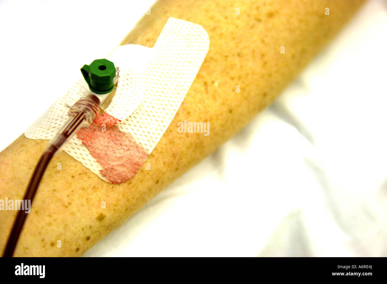 blood transfusion medical hospital patient female woman tube tubing arm ...