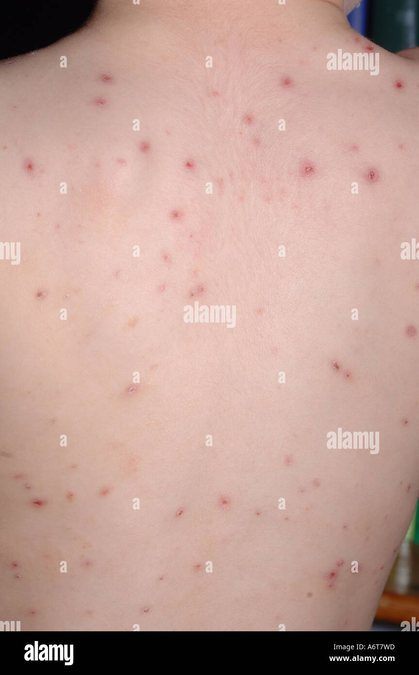 Young boy suffering with Chickenpox Stock Photo - Alamy