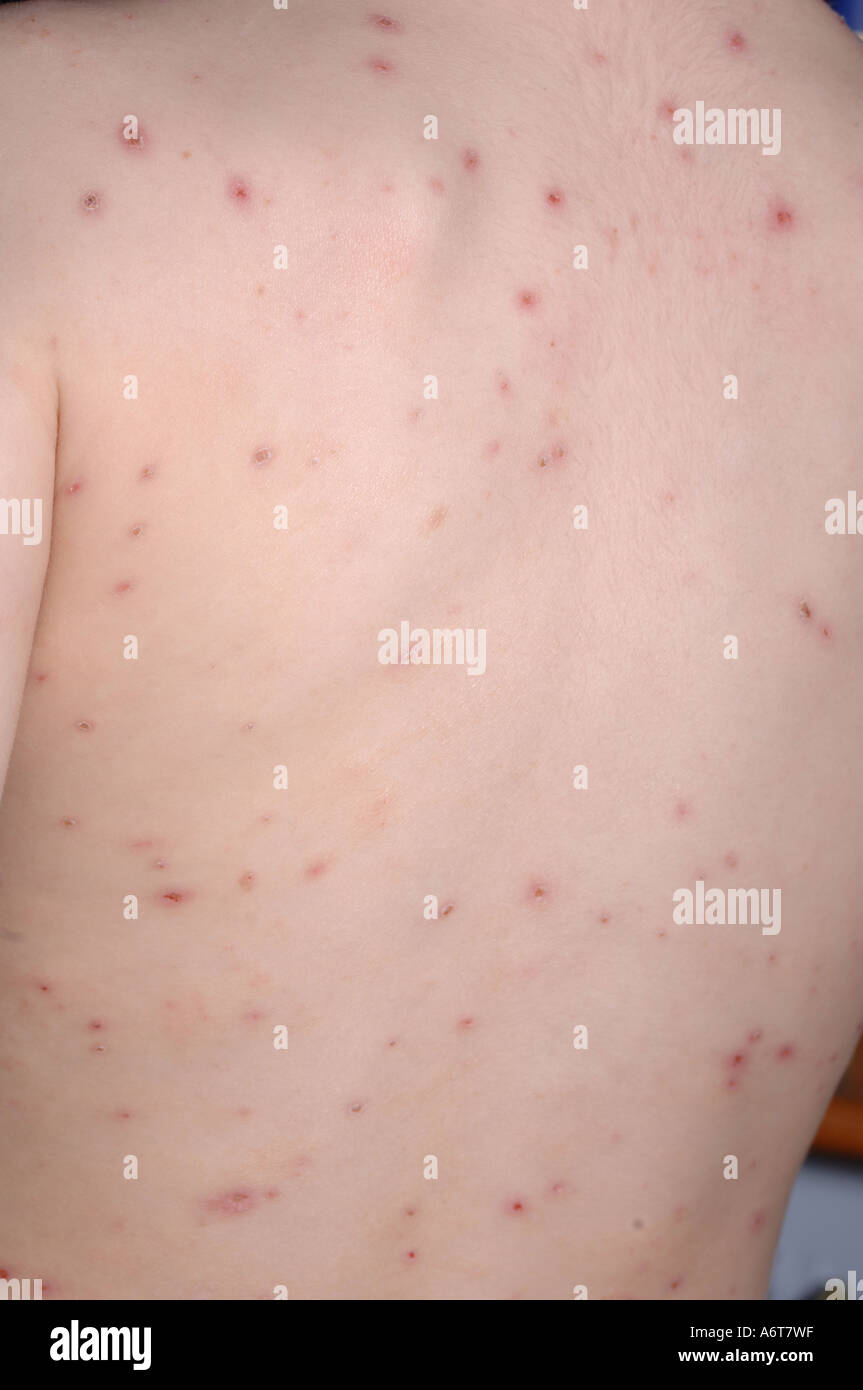 Young boy suffering with Chickenpox Stock Photo - Alamy