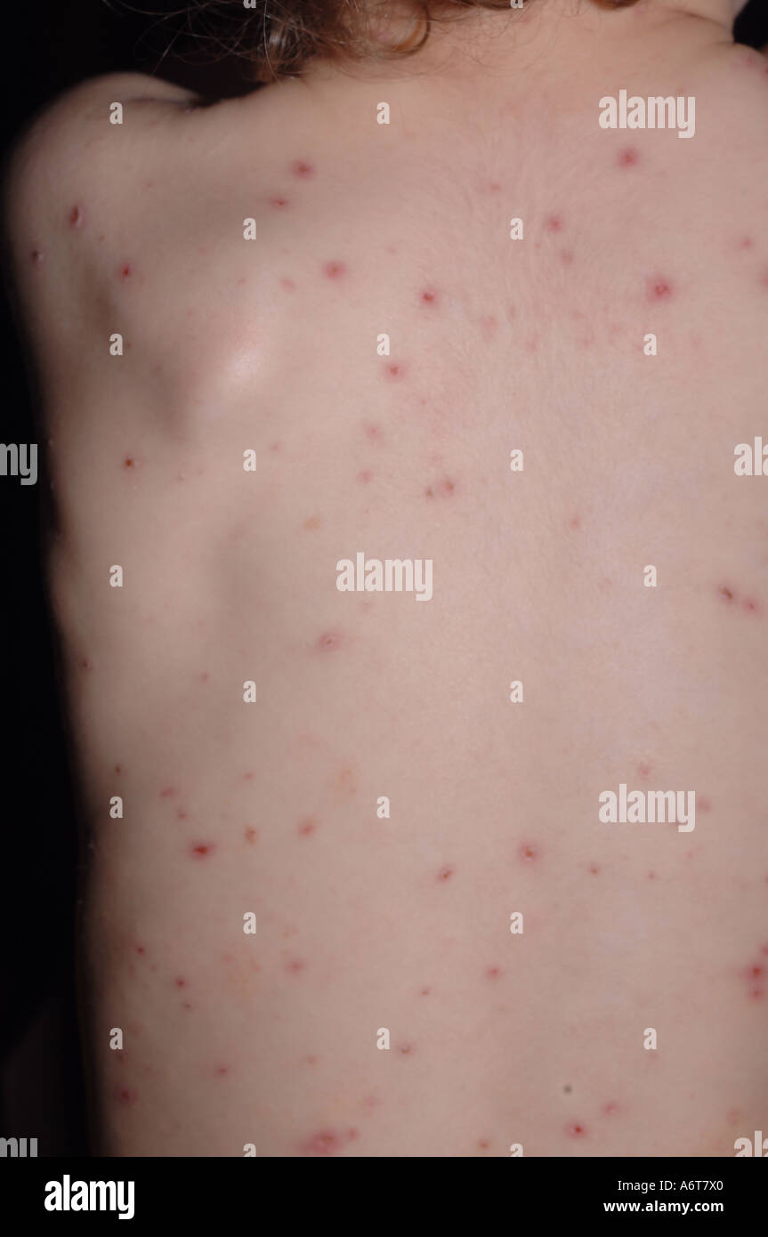 Young boy suffering with Chickenpox Stock Photo - Alamy