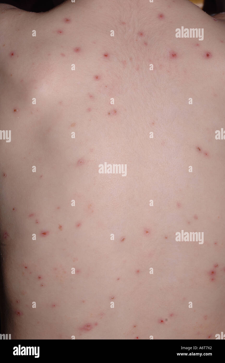 Young boy suffering with Chickenpox Stock Photo - Alamy