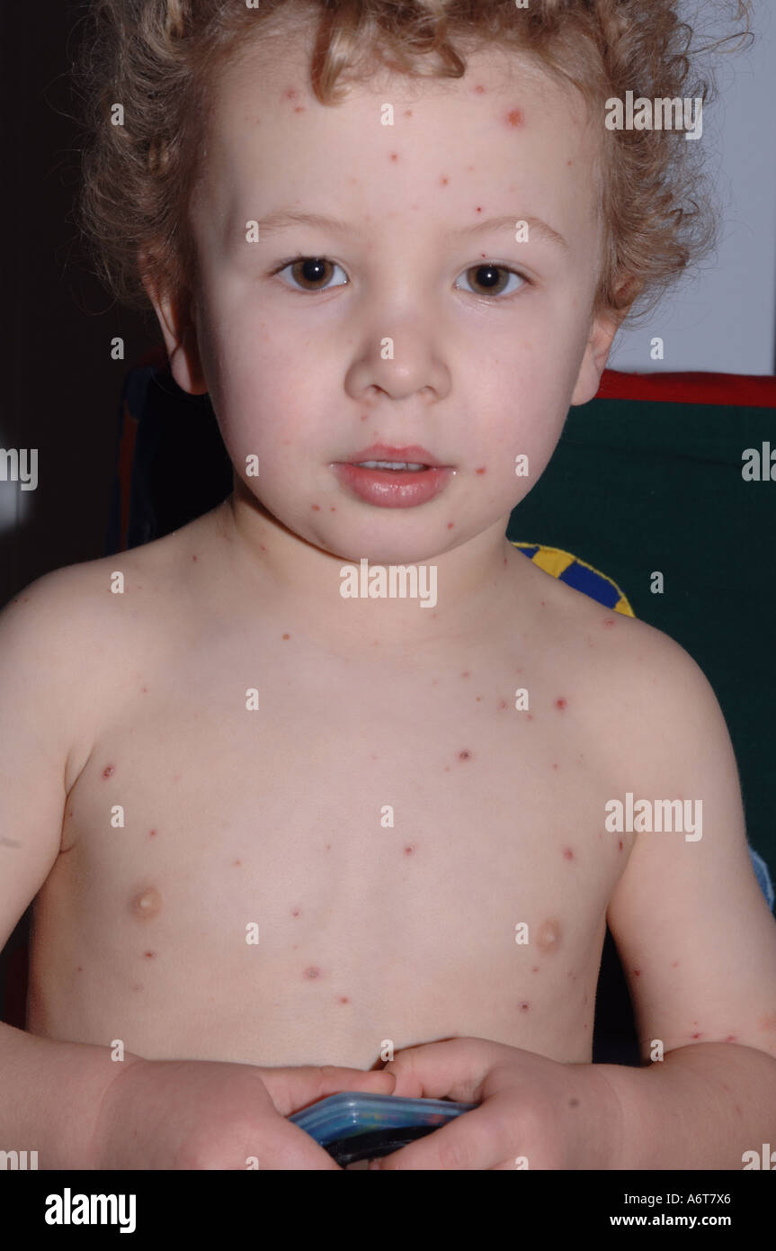 Young boy suffering with Chickenpox Stock Photo - Alamy